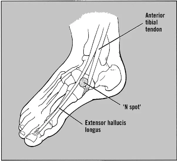 Navicular Stress Fractures A Review Sports Medicine Review
